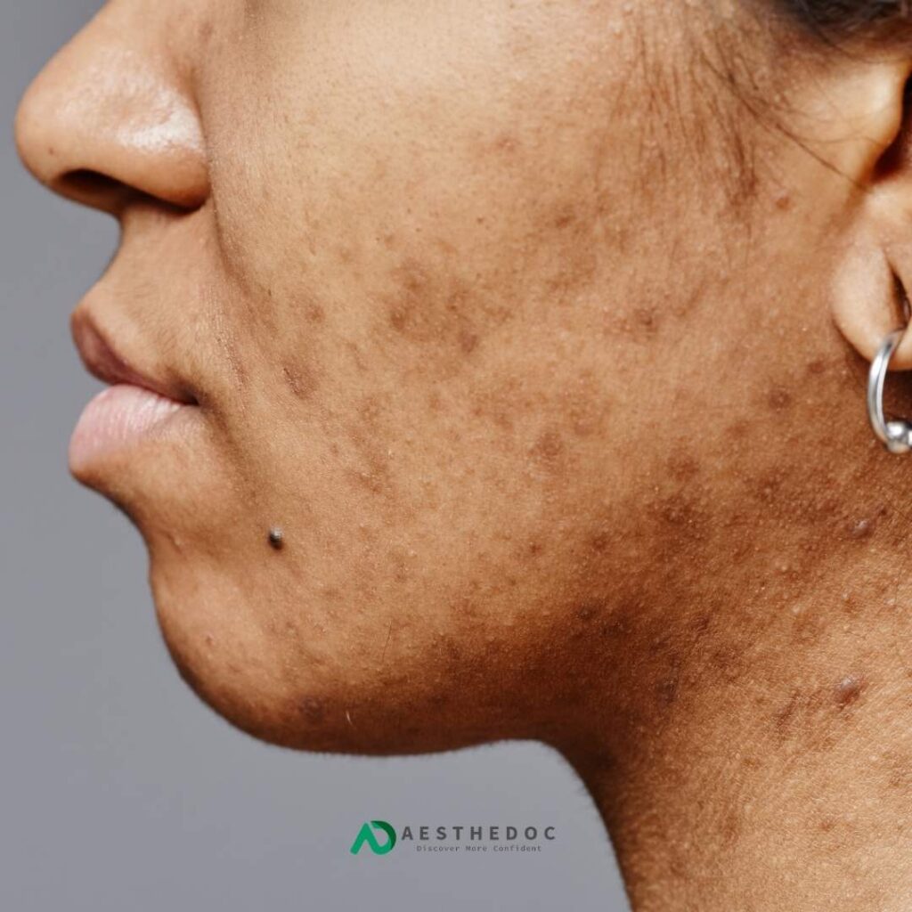 Face Pigmentation Treatment in Islamabad – Aesthedoc Clinic