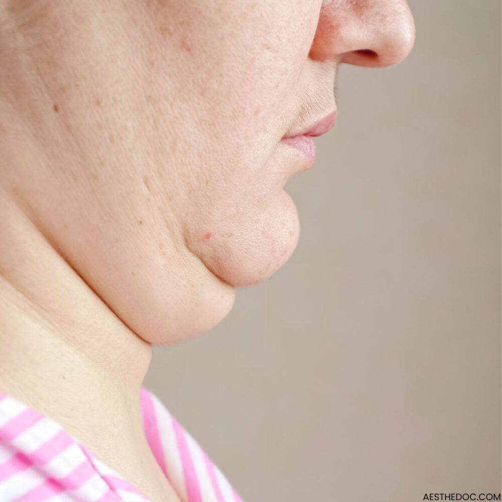 Double Chin Fat Reduction Treatment Options