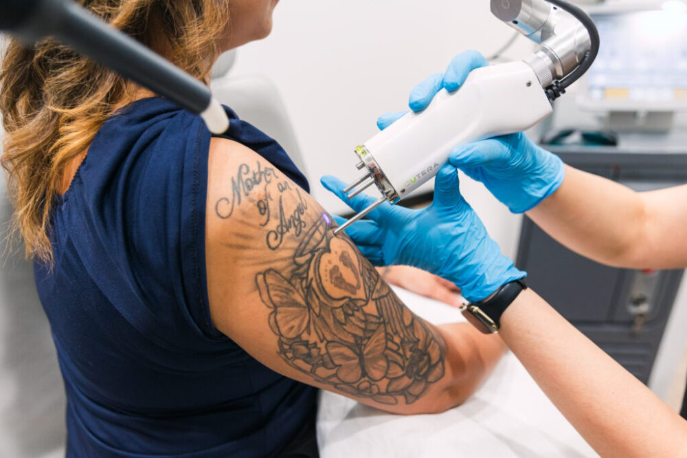 Effective Laser Tattoo Removal in Islamabad
